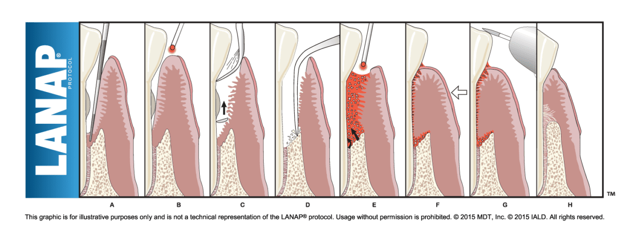LANAP - Eastmont Family Dental